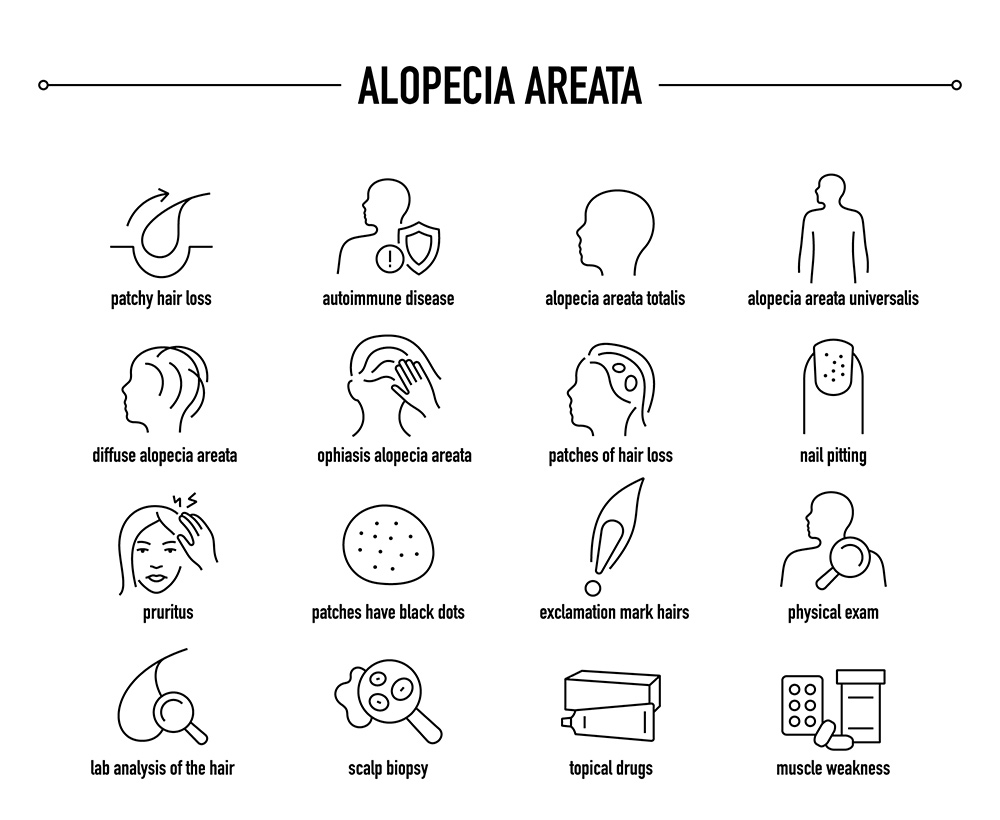 What Is Alopecia Areata? Symptoms, Causes and Treatment